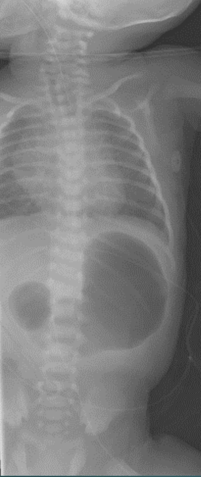 Double Bubble Duodenal Atresia