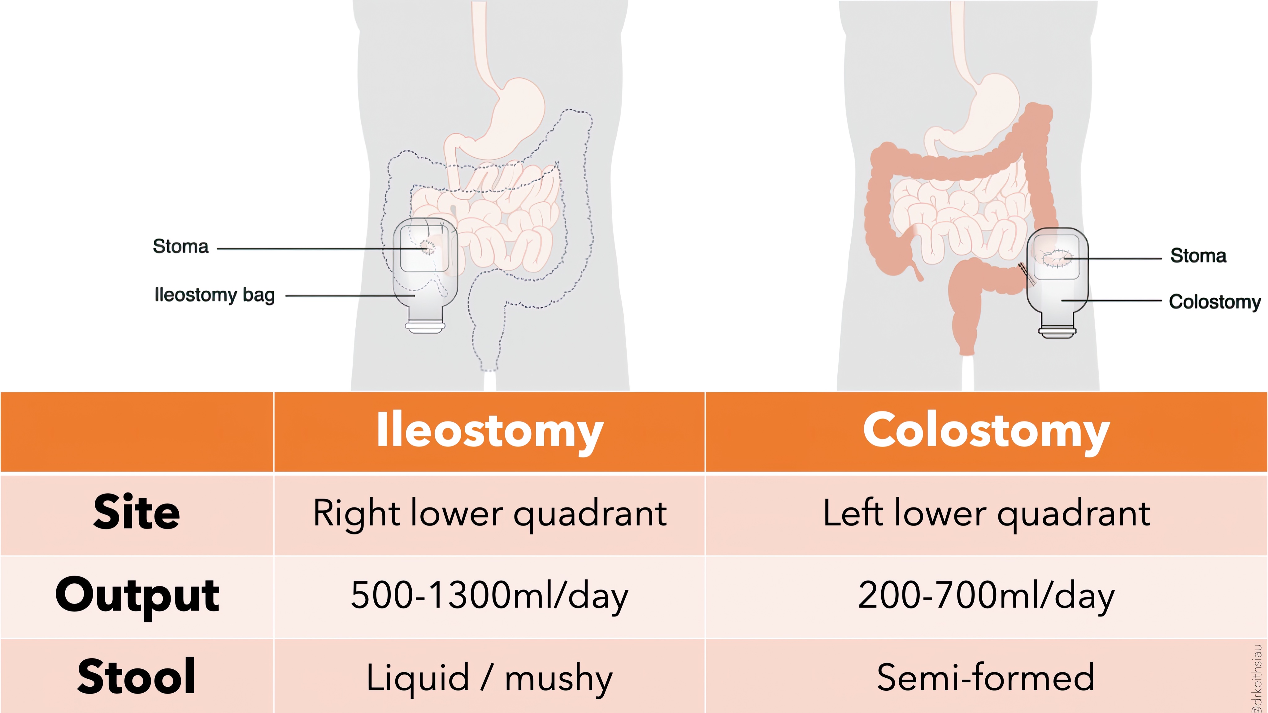 Ileostomy Vs Colostomy What Is The Difference