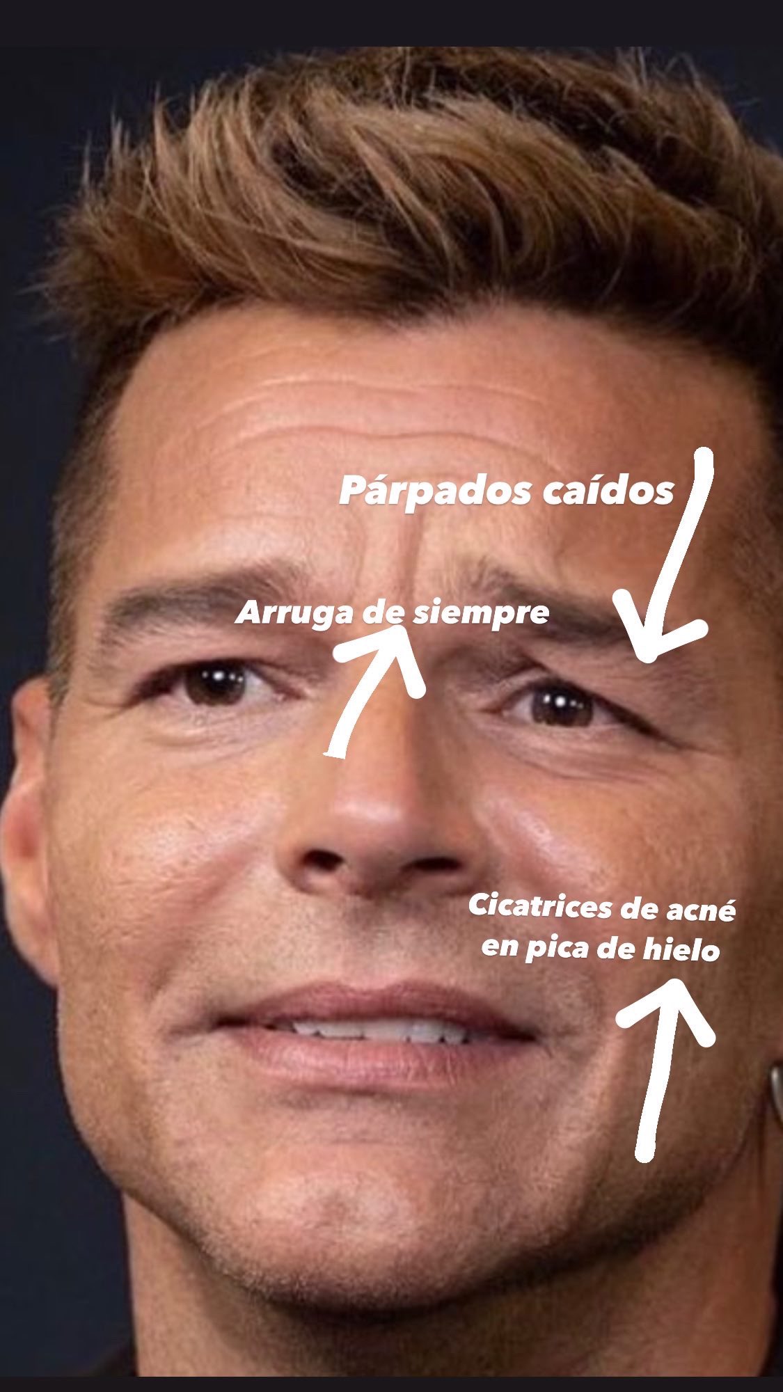 Ricky Martin Acne
