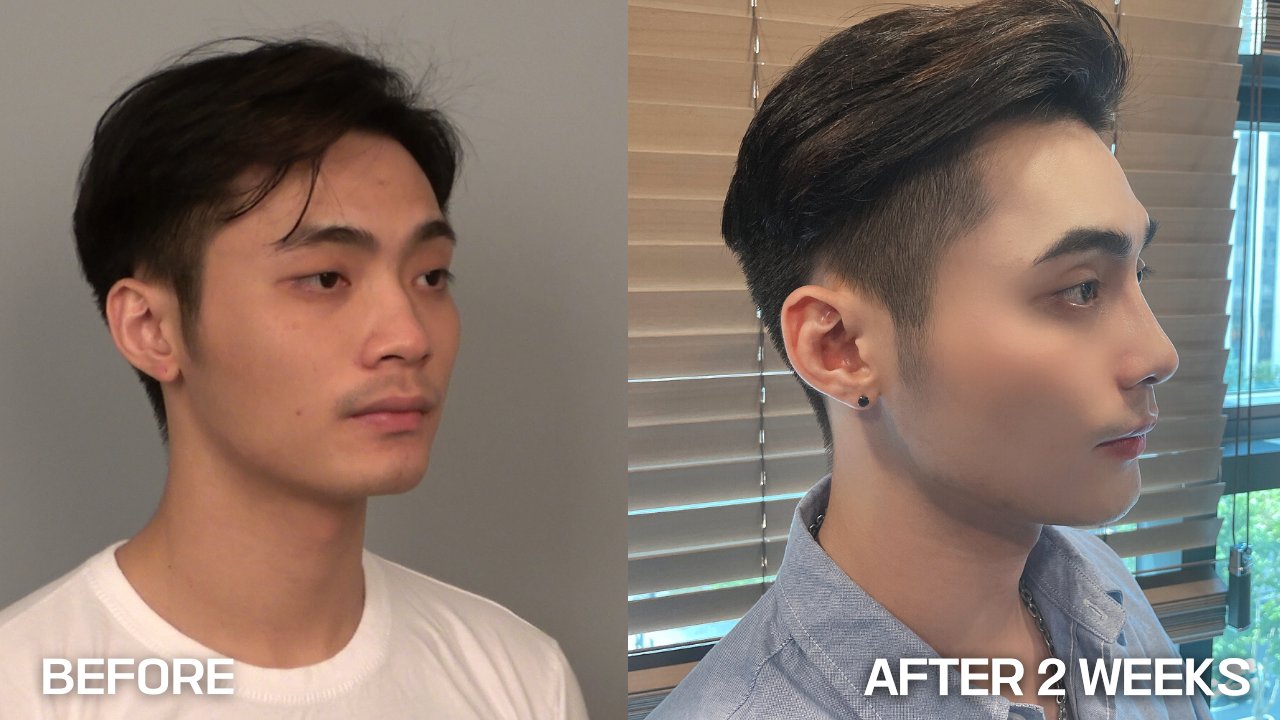 Plastic Surgery Before And After Nose Men