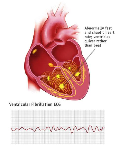 Ventricular Fibrillation Animation Ventricular Fibrillation Animation