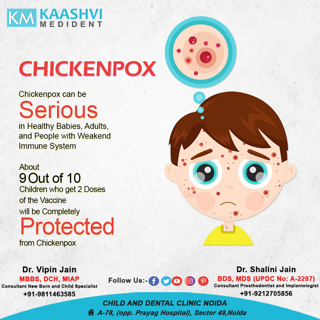 Chicken Pox Prevention