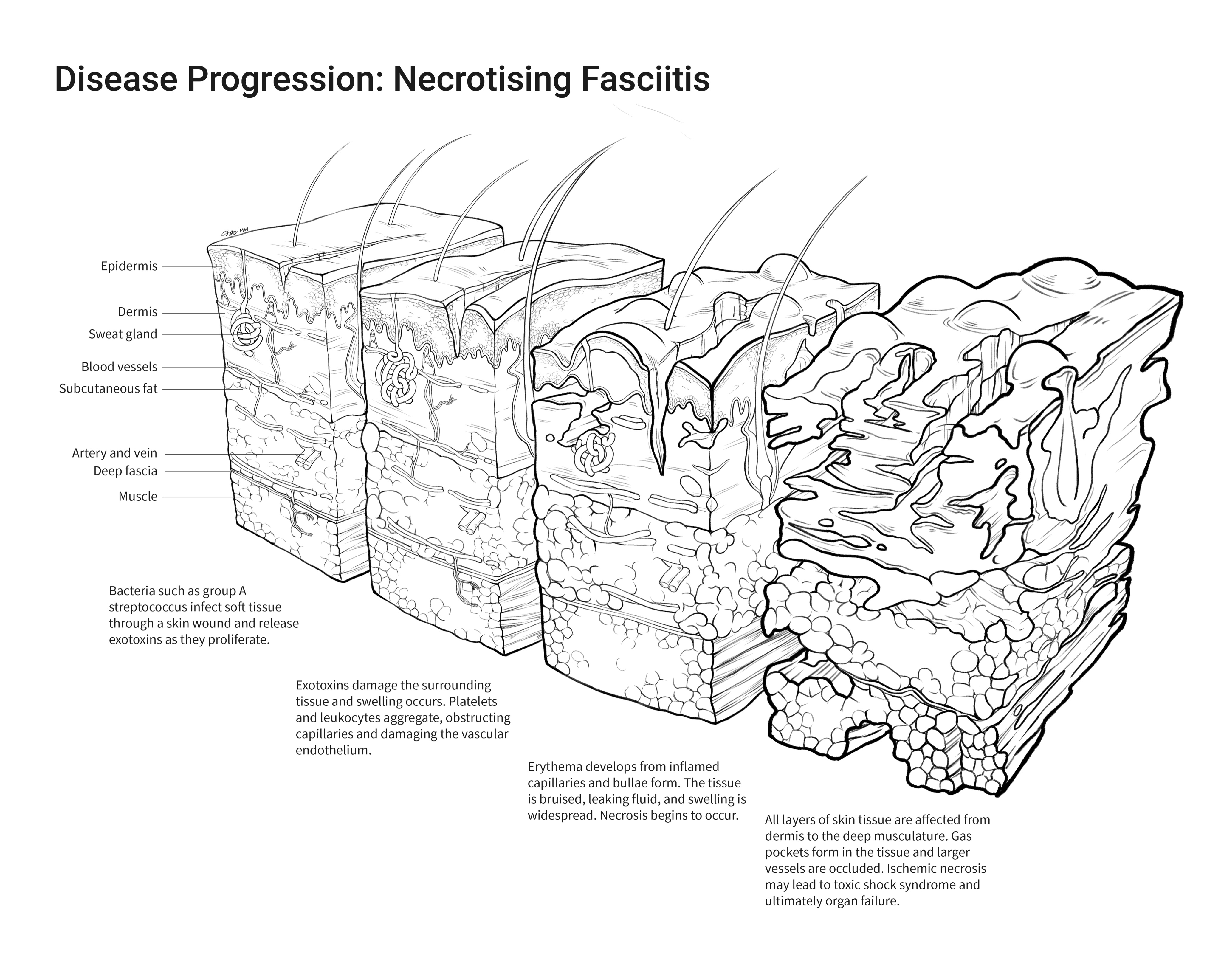 Necrotizing Fasciitis Diagram