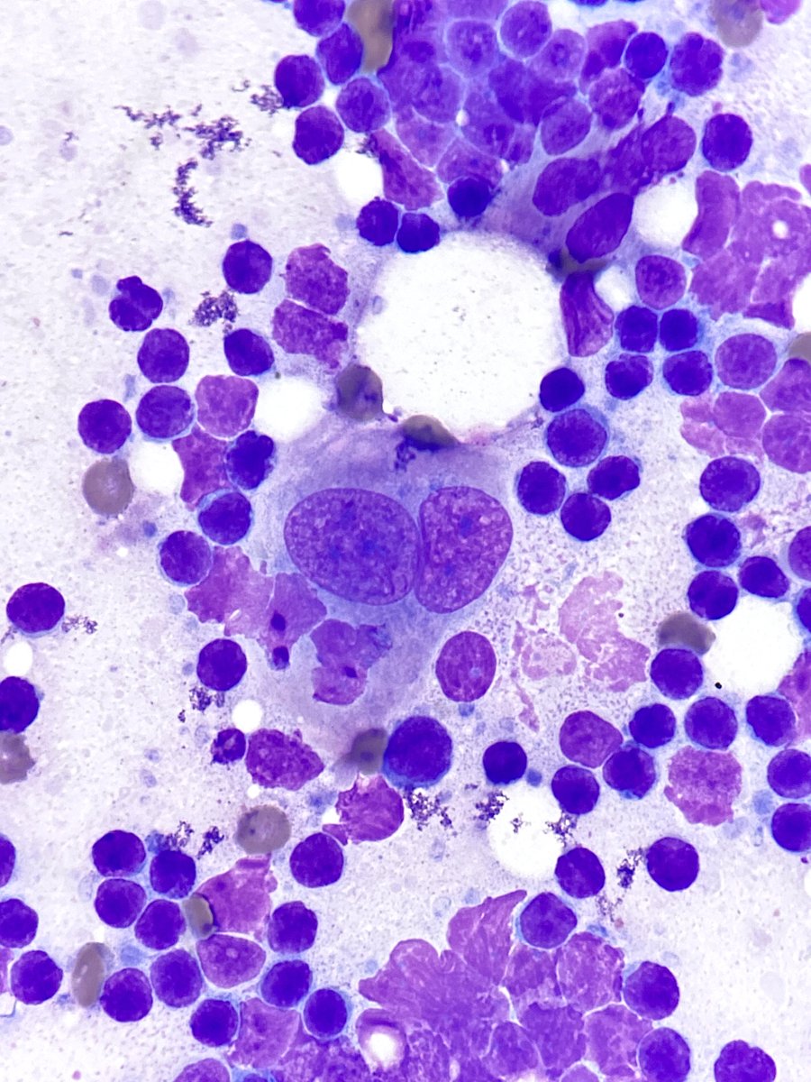 Reed Sternberg Cells