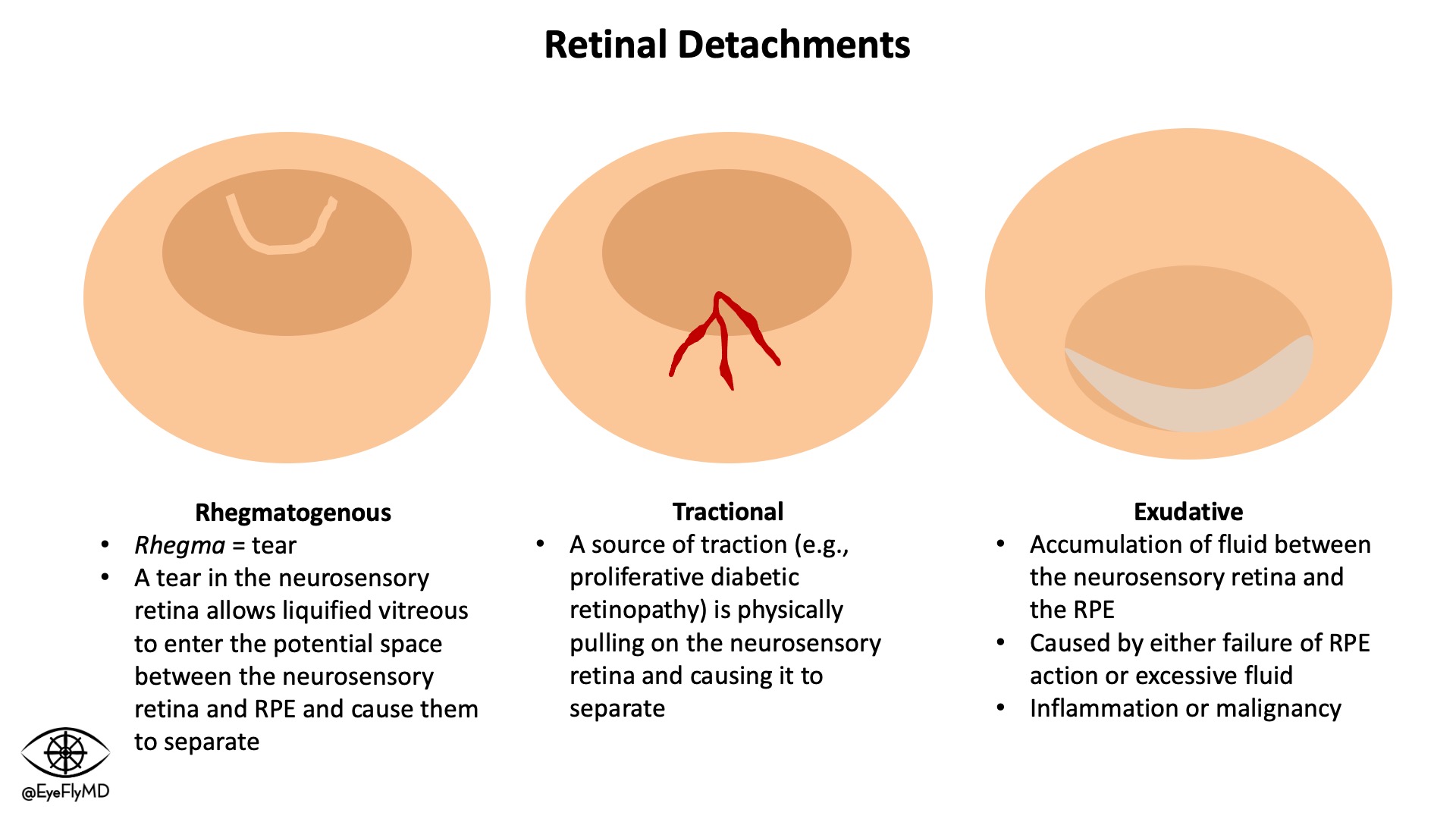 Tractional Retinal Detachment