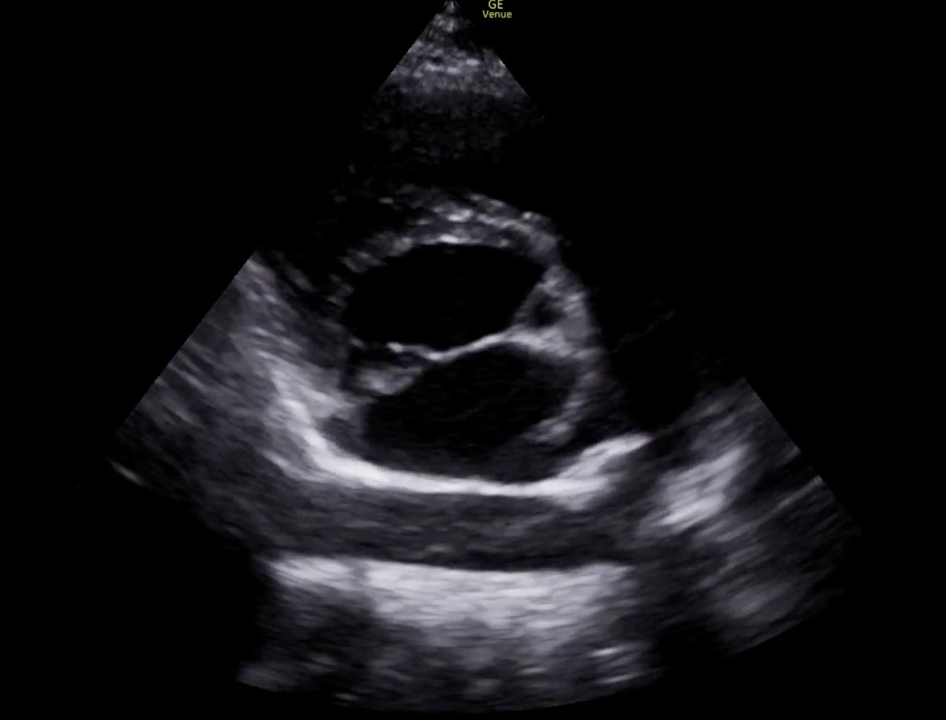 Thoracic Aortic Aneurysm Echocardiogram