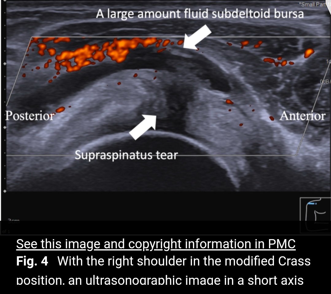 Subdeltoid Bursitis Ultrasound