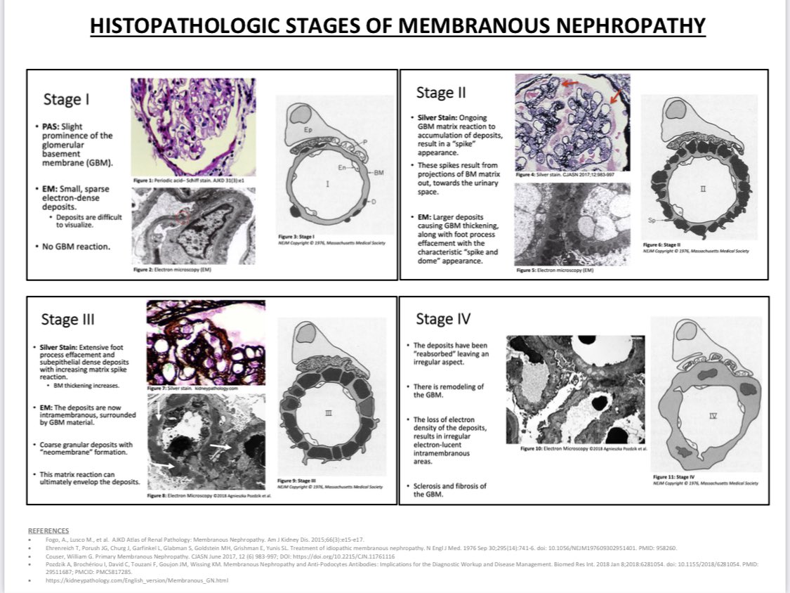 Membranous Nephropathy Spike And Dome