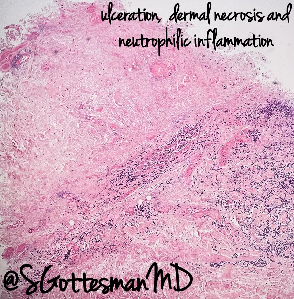 Ecthyma Gangrenosum Histology