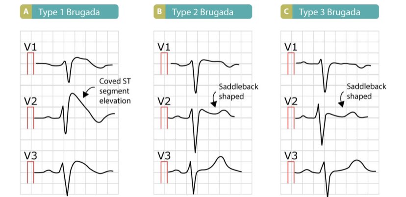 Brugada Syndrome Type 3