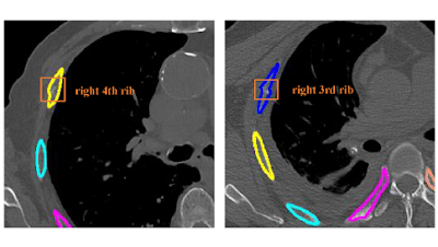 Radiology: Artificial Intelligence on Twitter: "#DeepLearning algorithm detects and labels rib ...