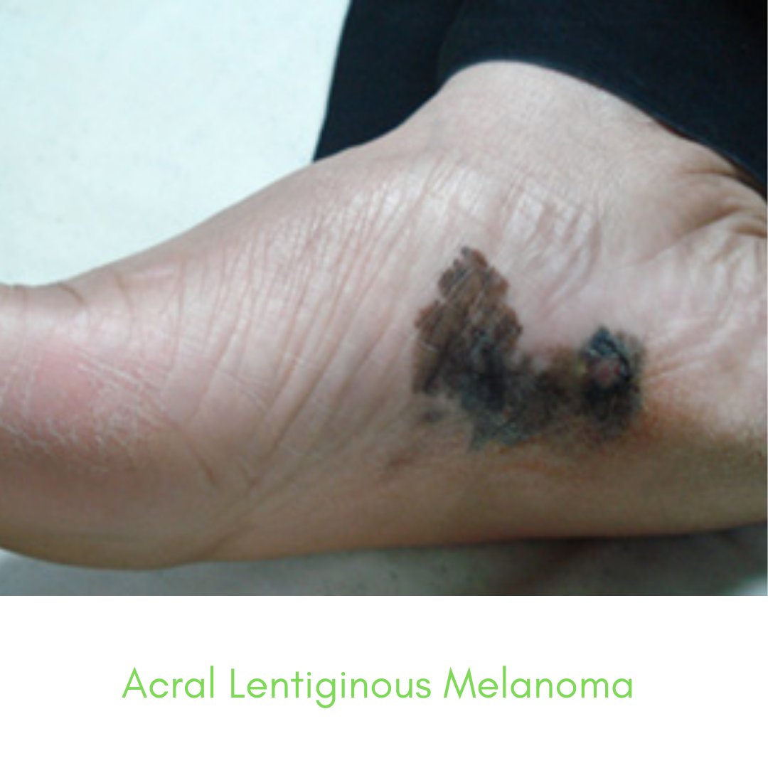 Acral Lentiginous Melanoma Bob Marley