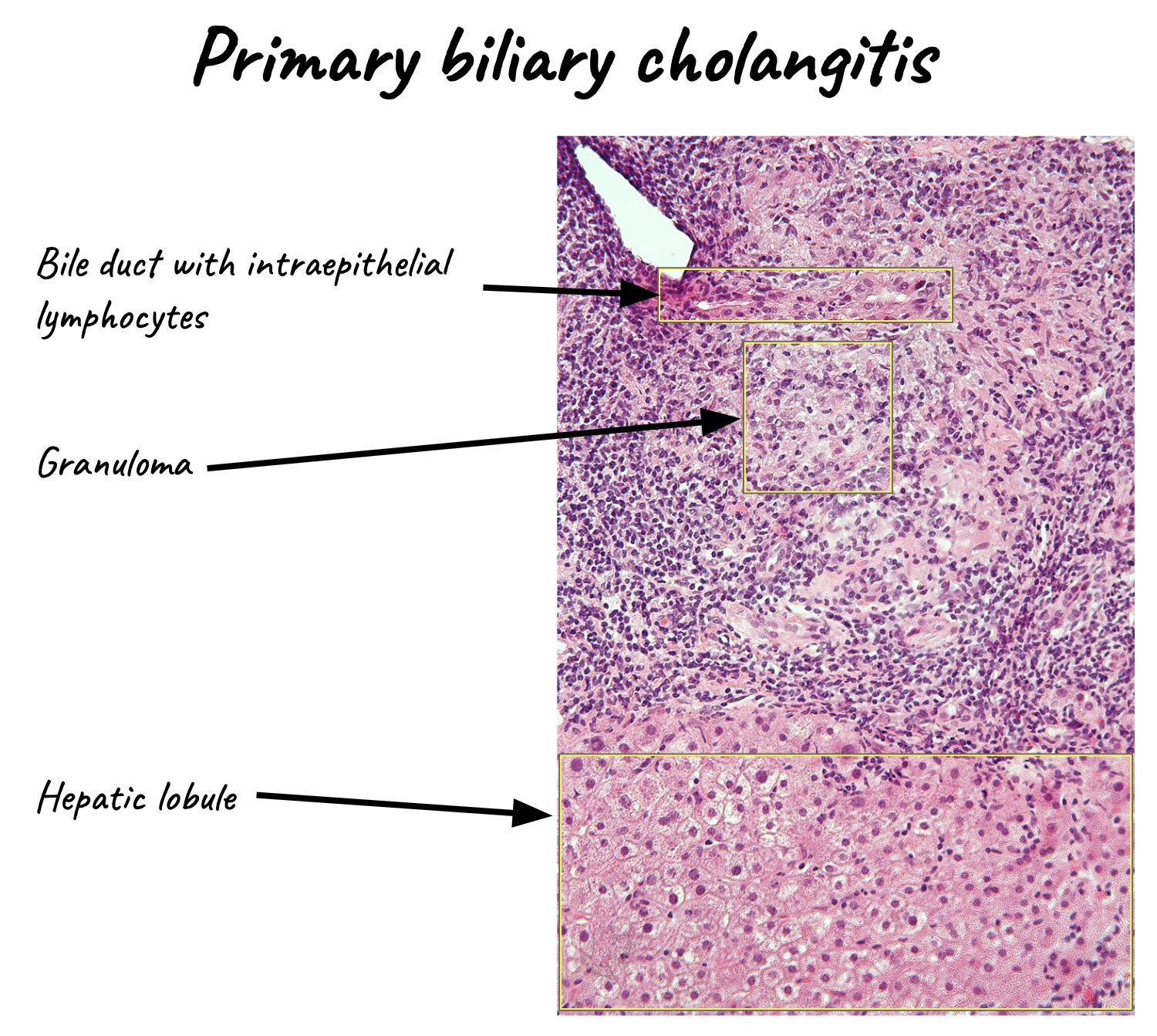Interlobular Bile Duct