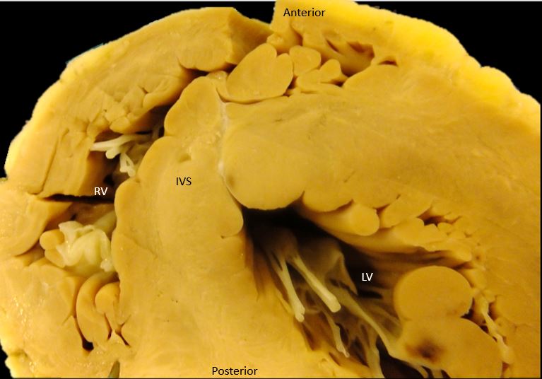 Interthalamic Adhesion Sheep Brain