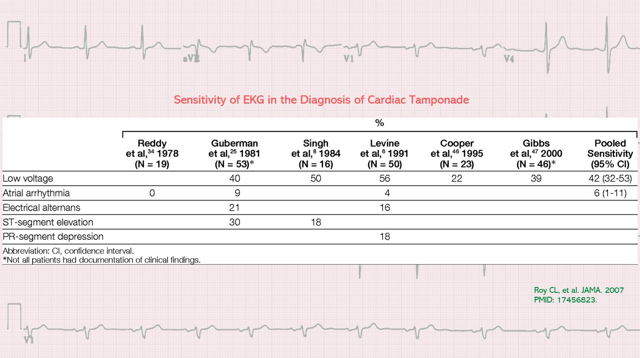 Cardiac Tamponade Ecg