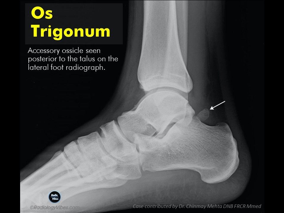 Accessory Ossicles Foot