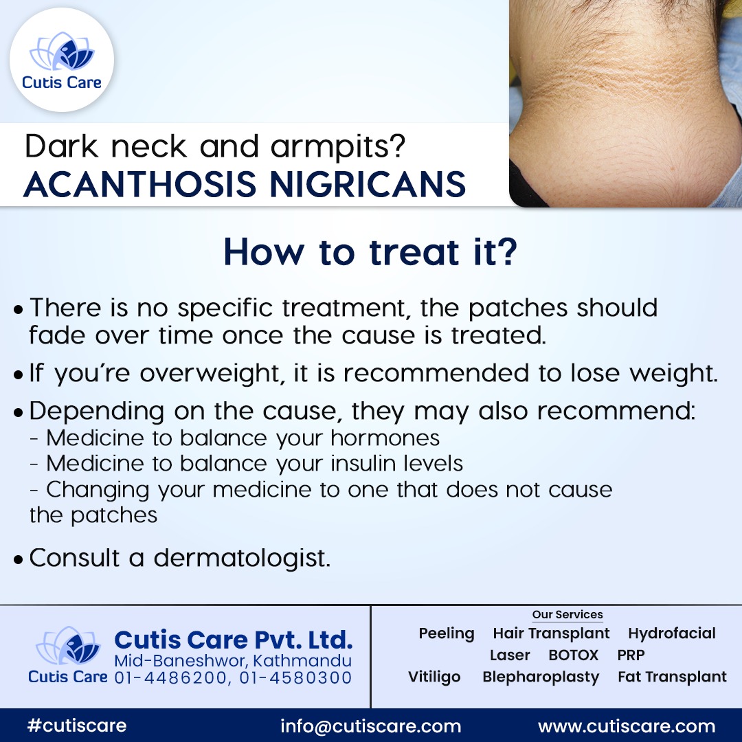 Acanthosis Nigricans Pcos