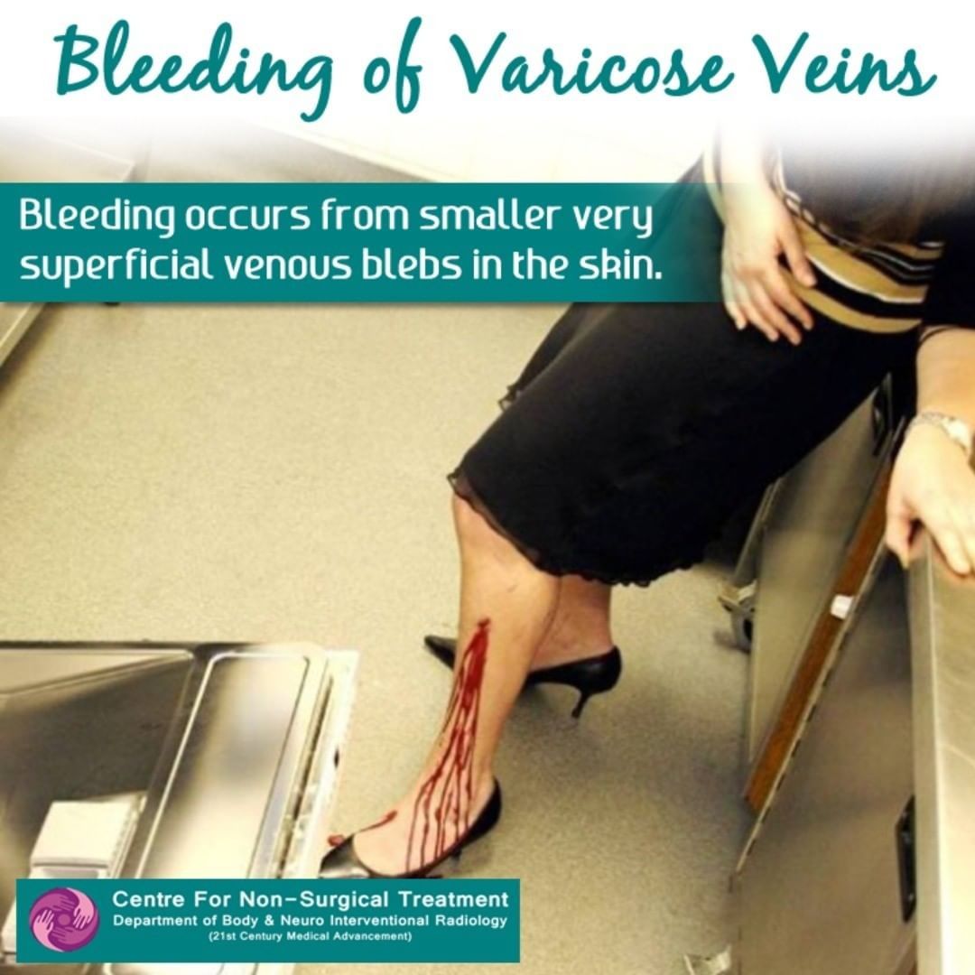 Veins Bleeding
