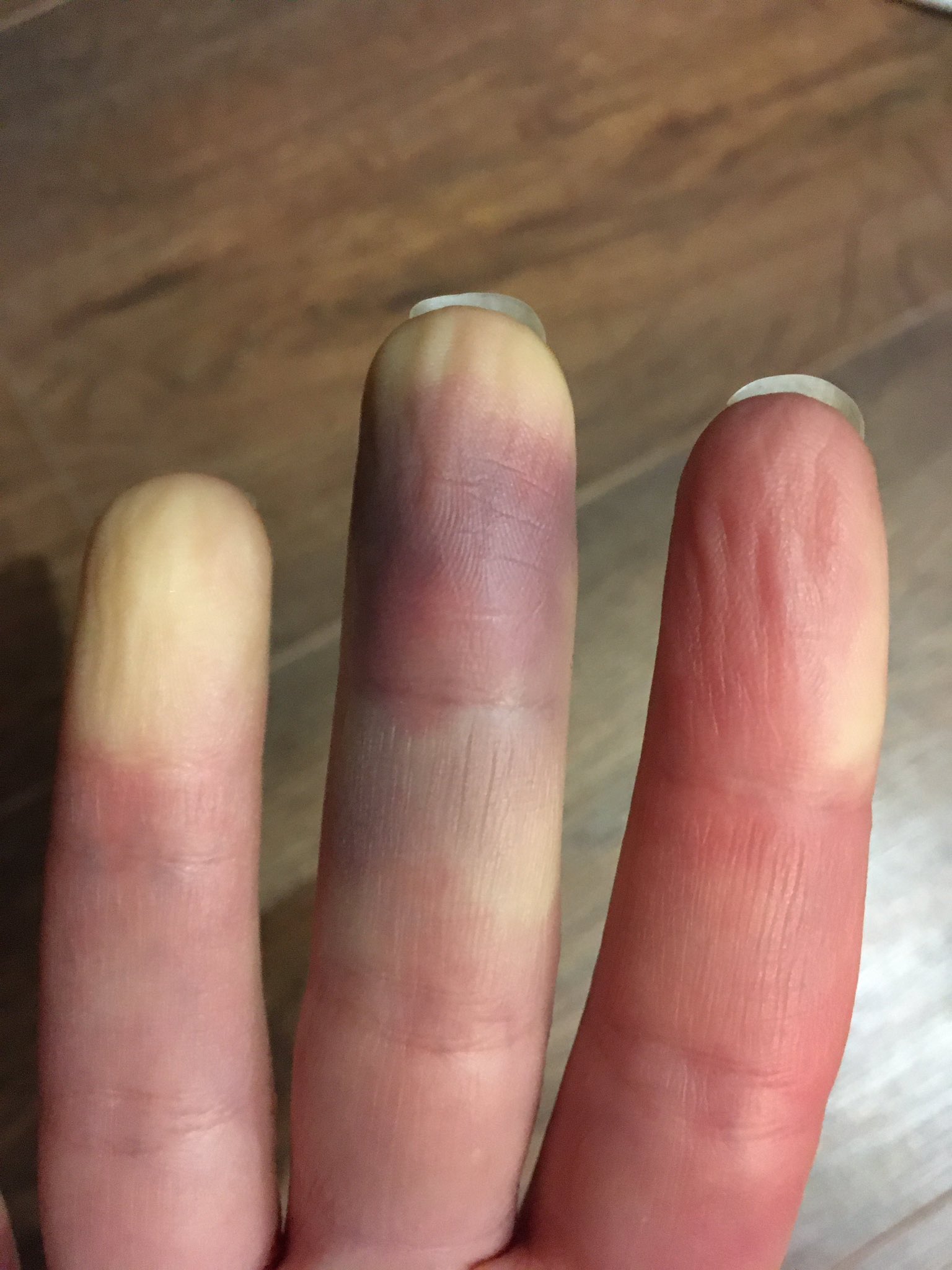 Bruised Middle Finger