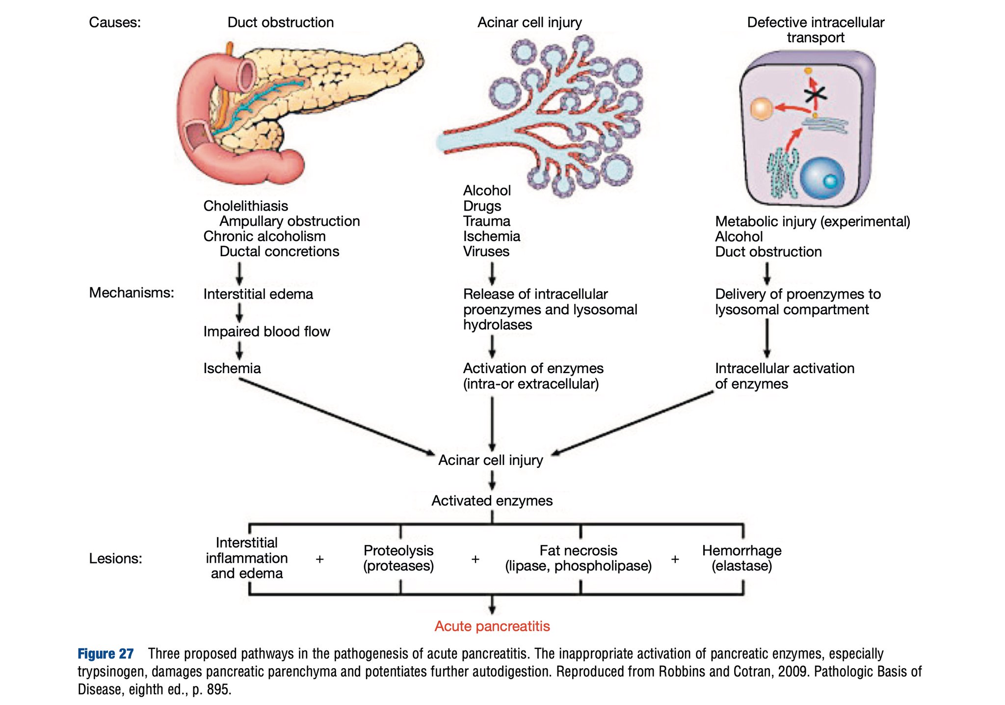 Chronic Pancreatitis Pathogenesis