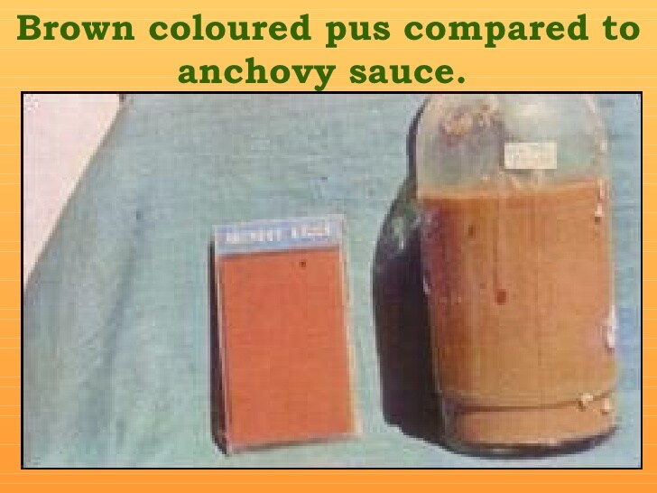 Anchovy Sauce Liver Abscess