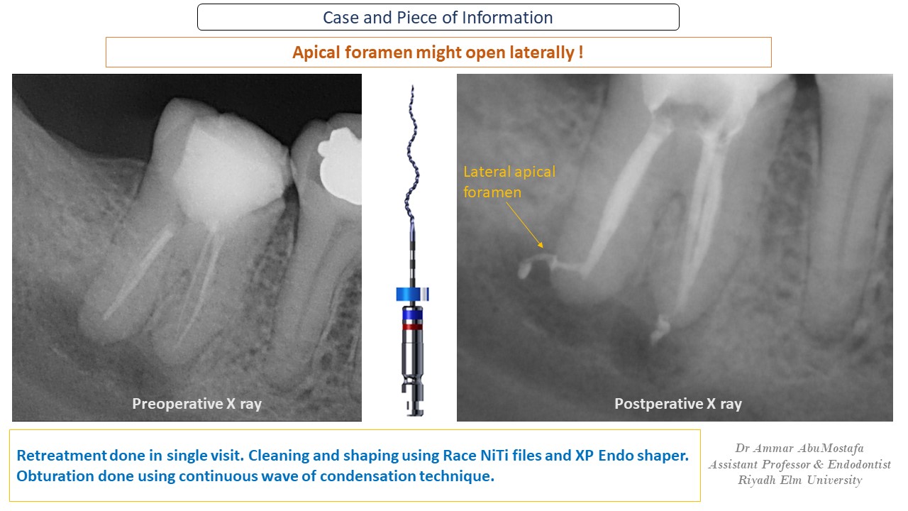 Apical Foramen