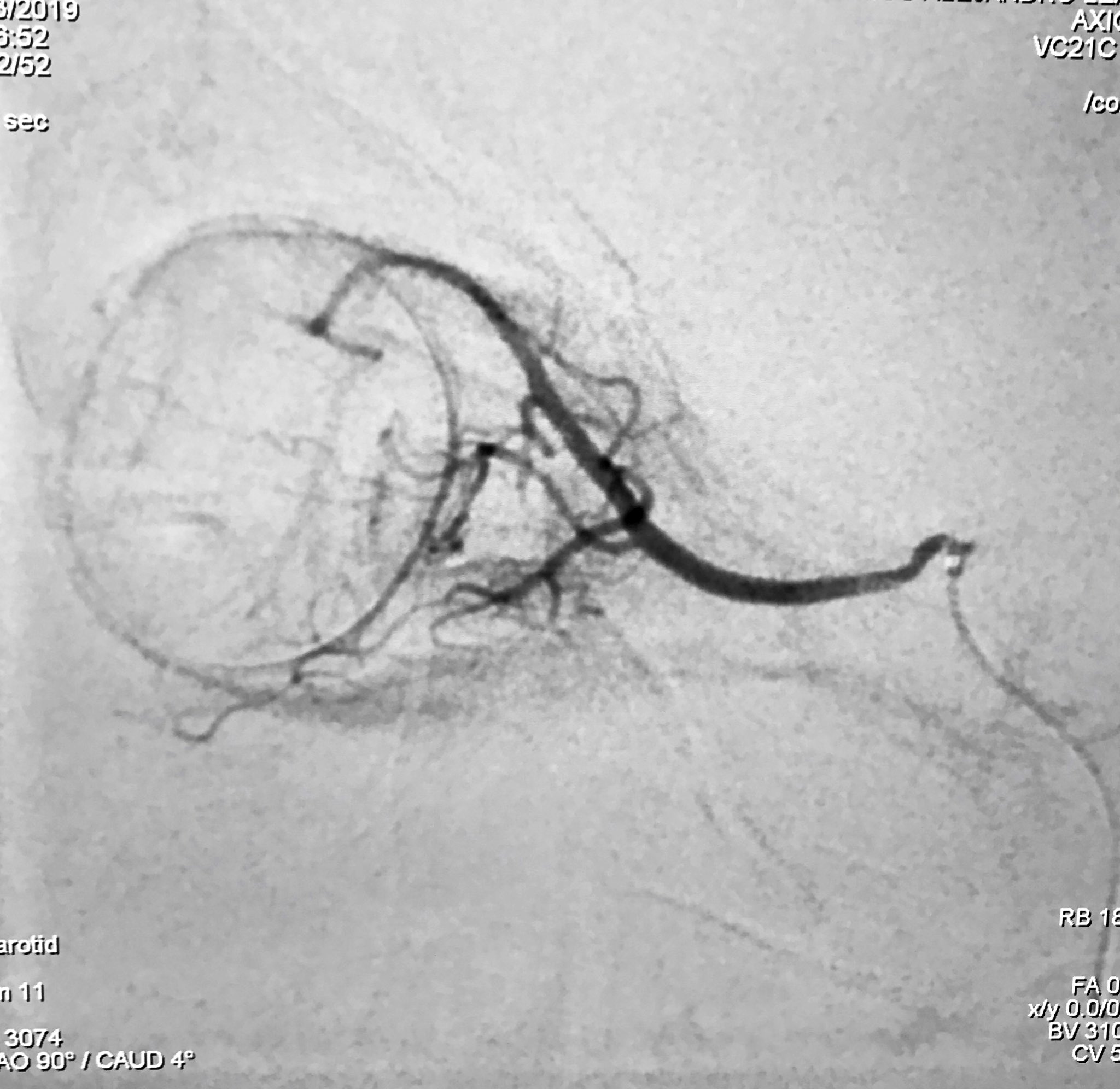 Retinoblastoma Drawing
