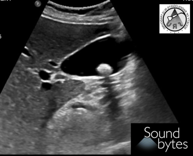 Gallbladder Polyps Ultrasound