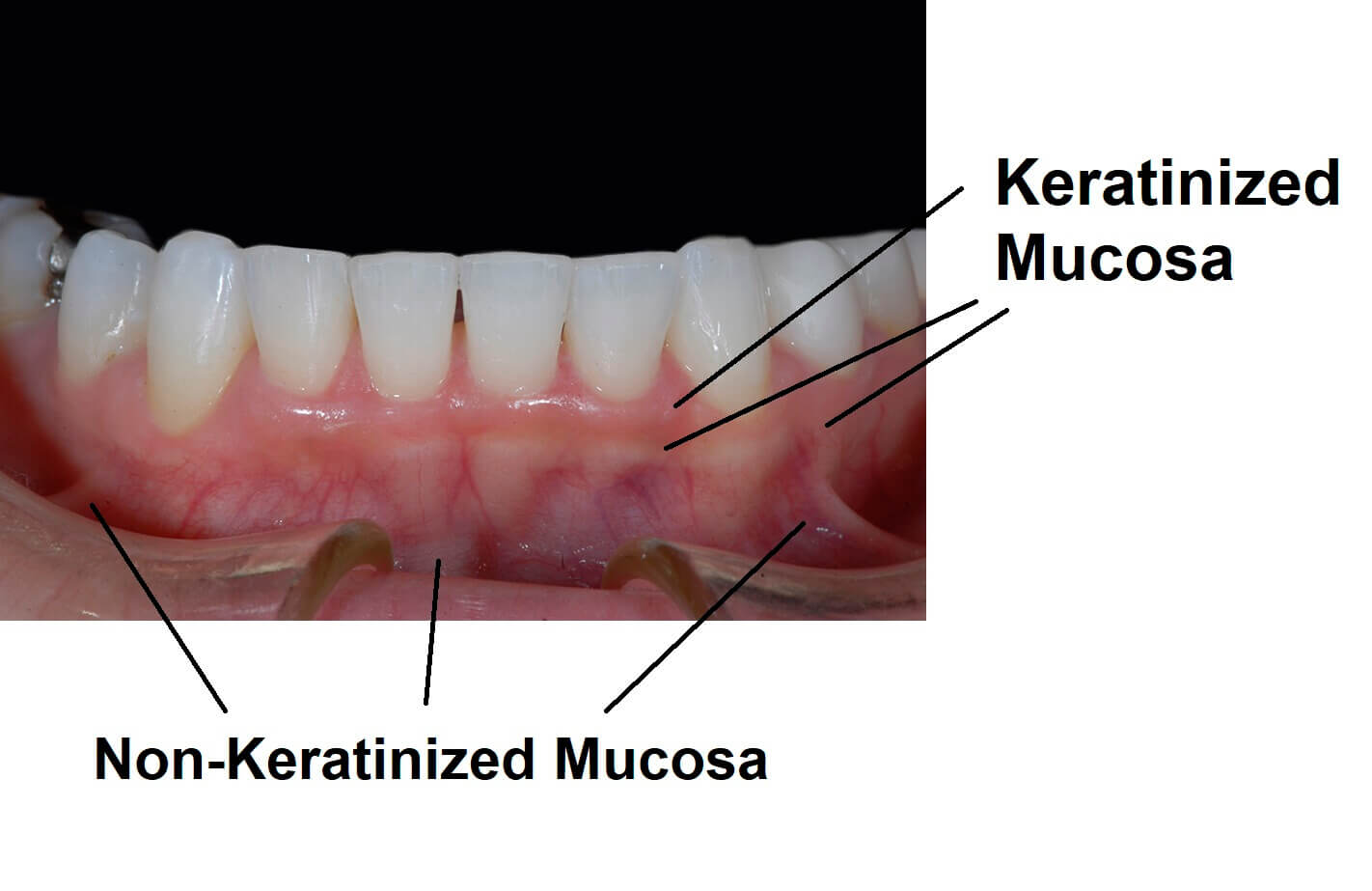 Non Keratinized Mucosa