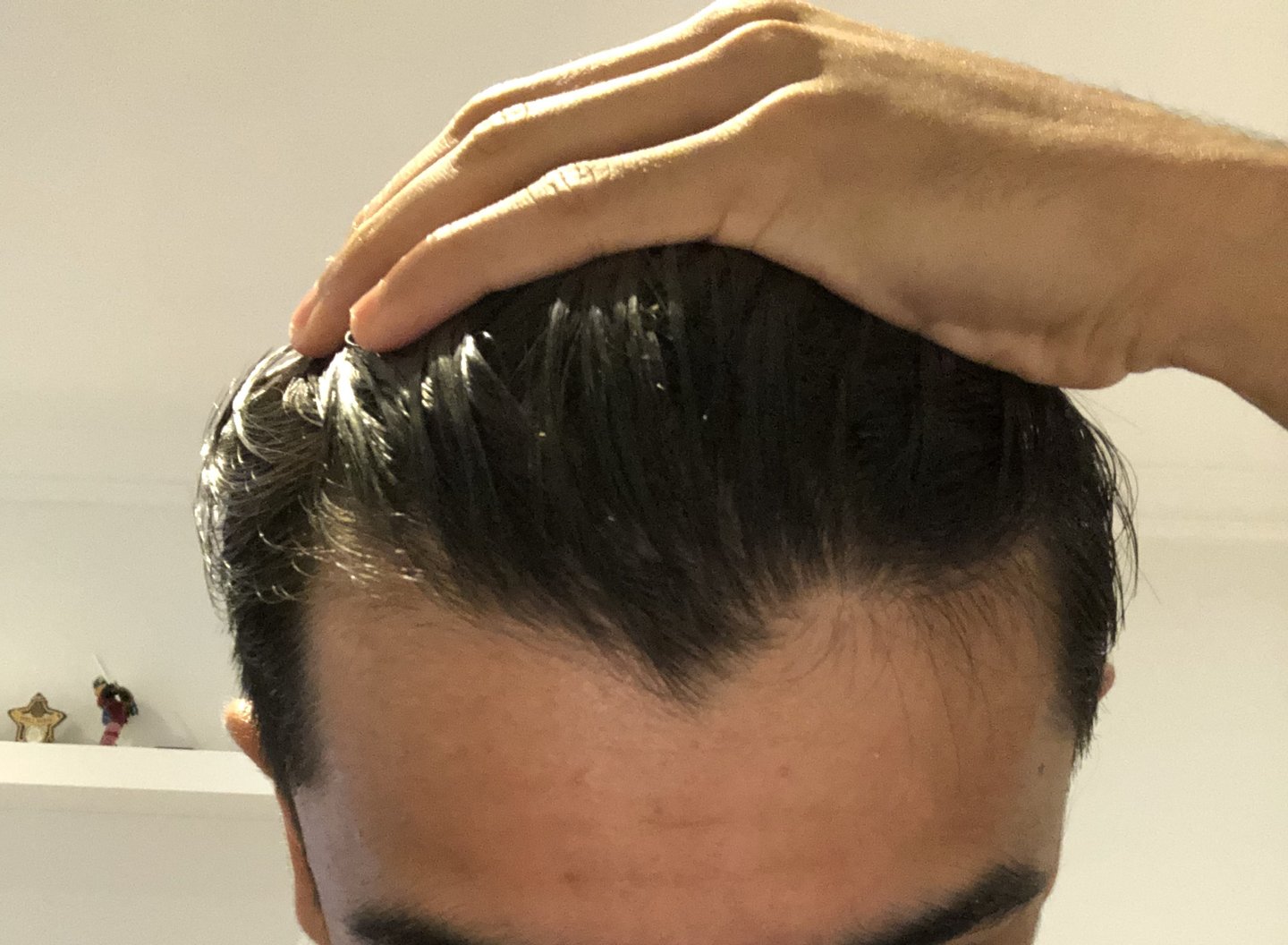 Receding Hairline Signs