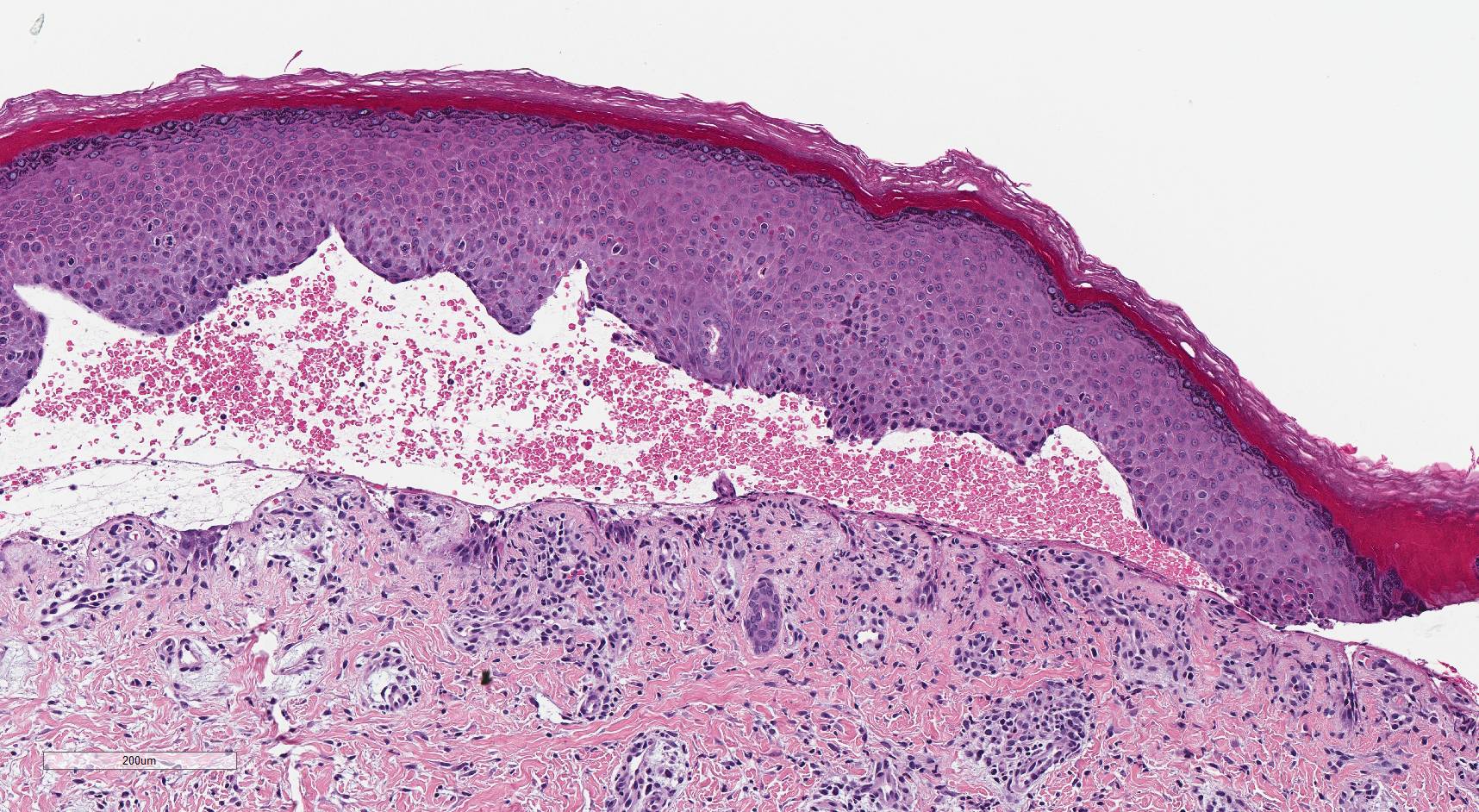Epidermolysis Bullosa Histology Histopathology Of Autoimmune Bullous
