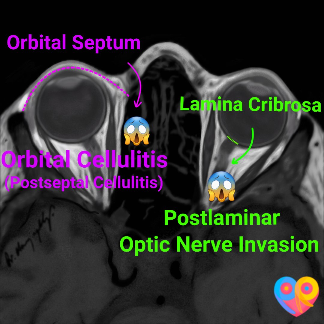 Orbital Septum Anatomy