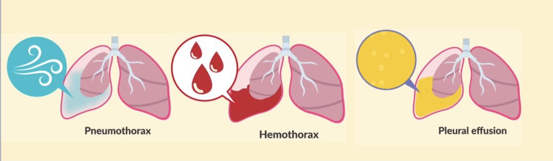 Hemothorax Vs Pneumothorax Hemothorax: Causes, Symptoms, Treatment And