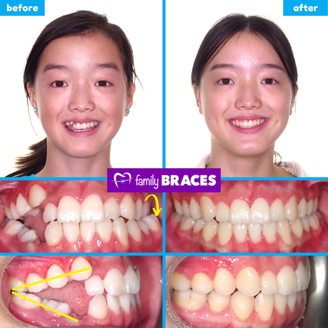 Crossbite Invisalign