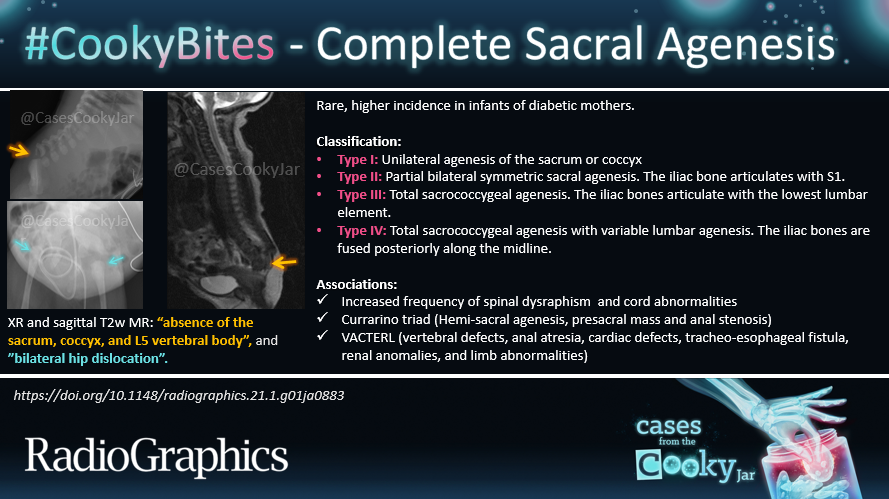 Sacral Agenesis
