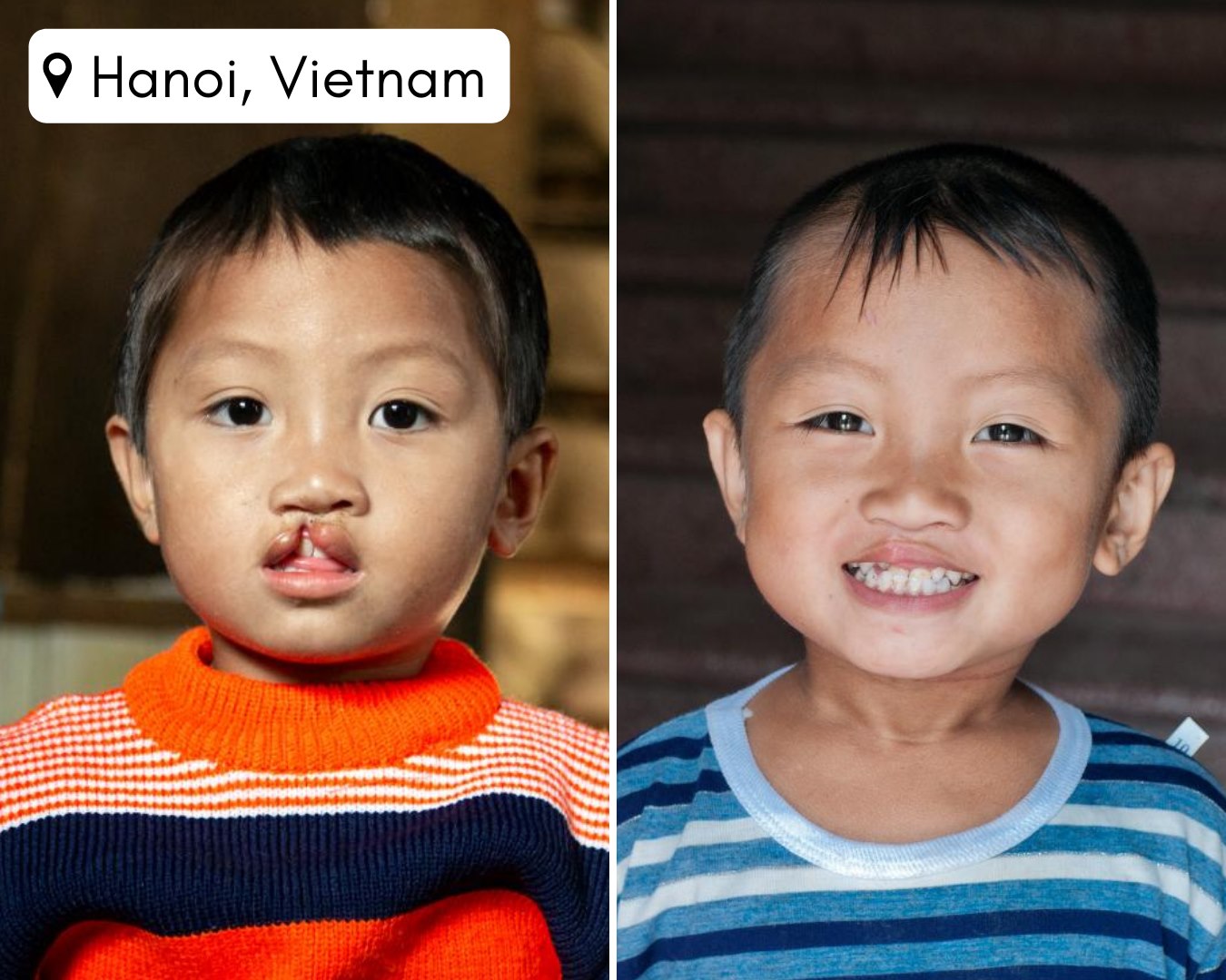 Operation Smile Before And After