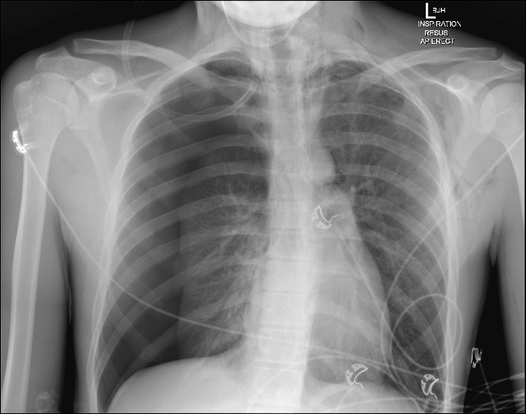 Tracheal Deviation Tension Pneumothorax