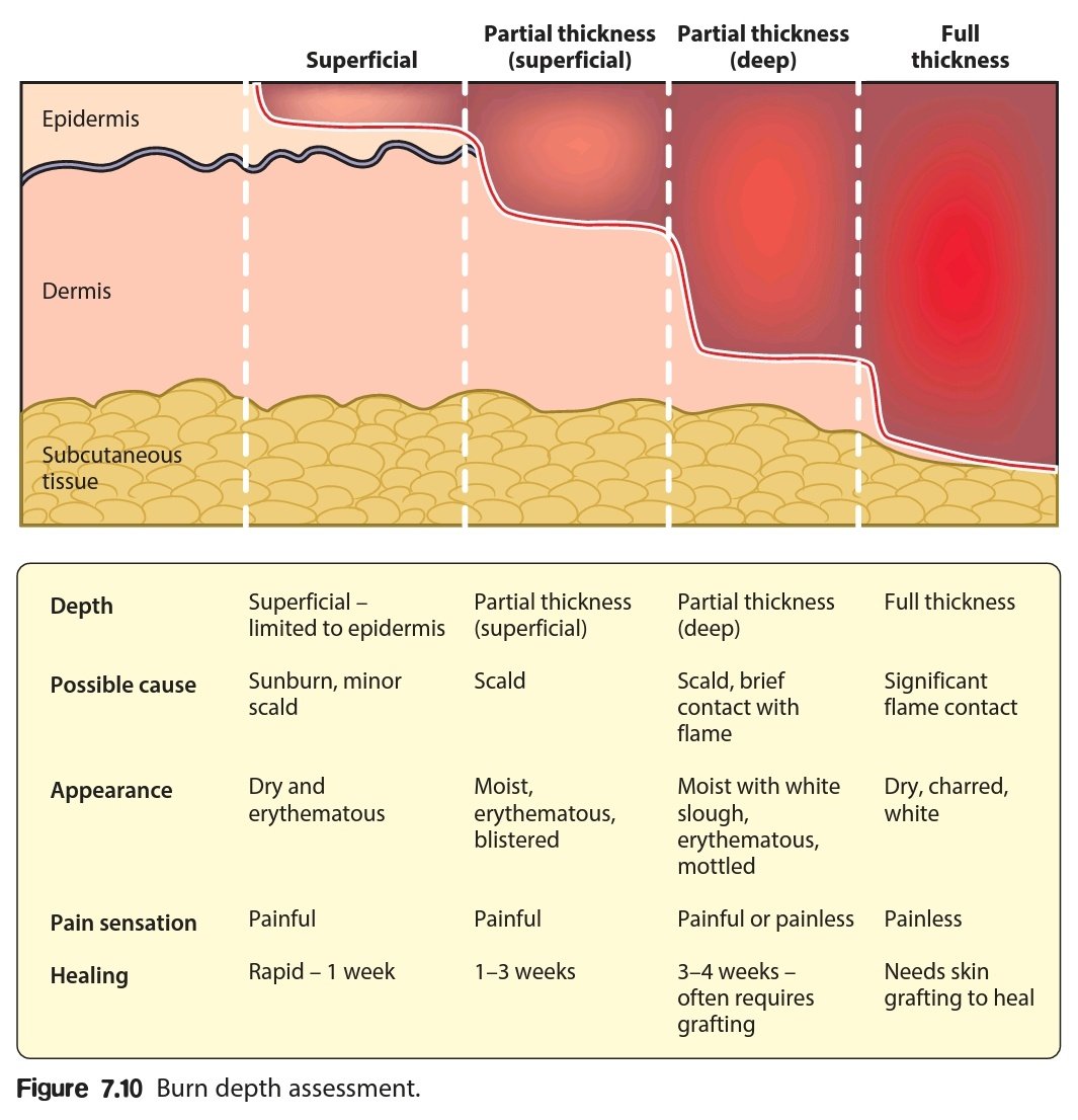 Illustration Of Burn Depth