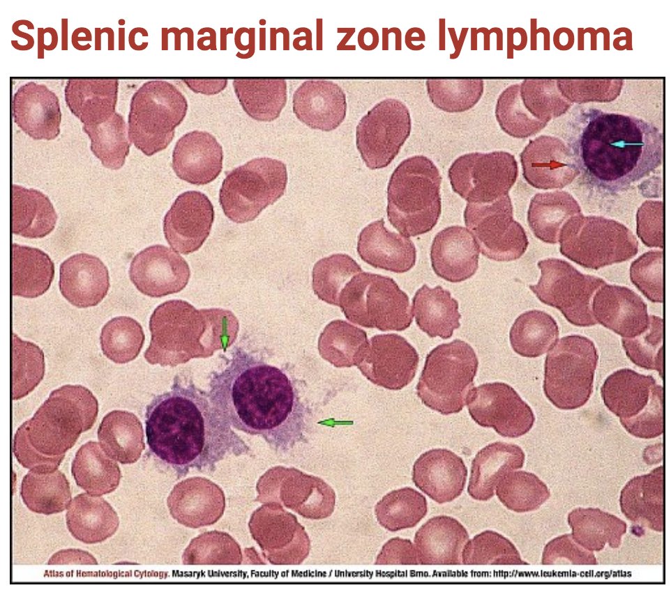 73M presents with a LUQ abdominal mass gradually enlarging over the ...