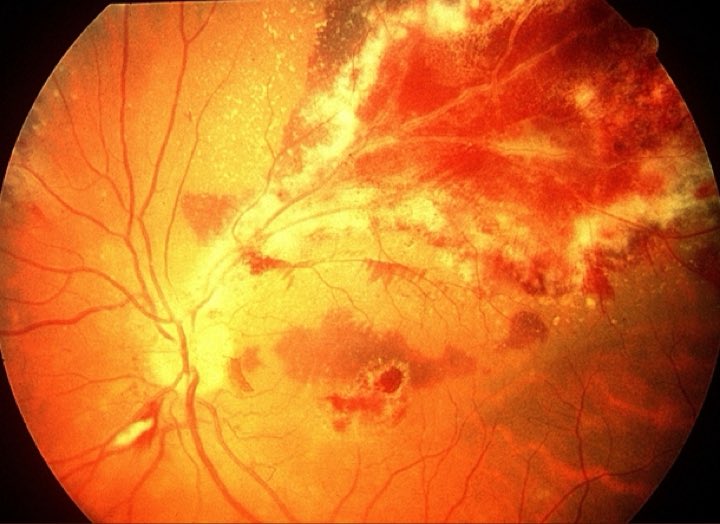 Cmv Retinitis Pizza Pie