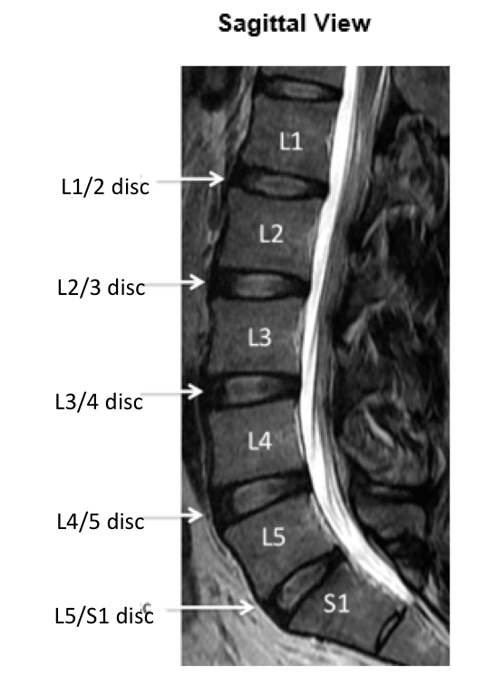 Basics of Lumbar MRIs: Part 3 – @PalingClaire
