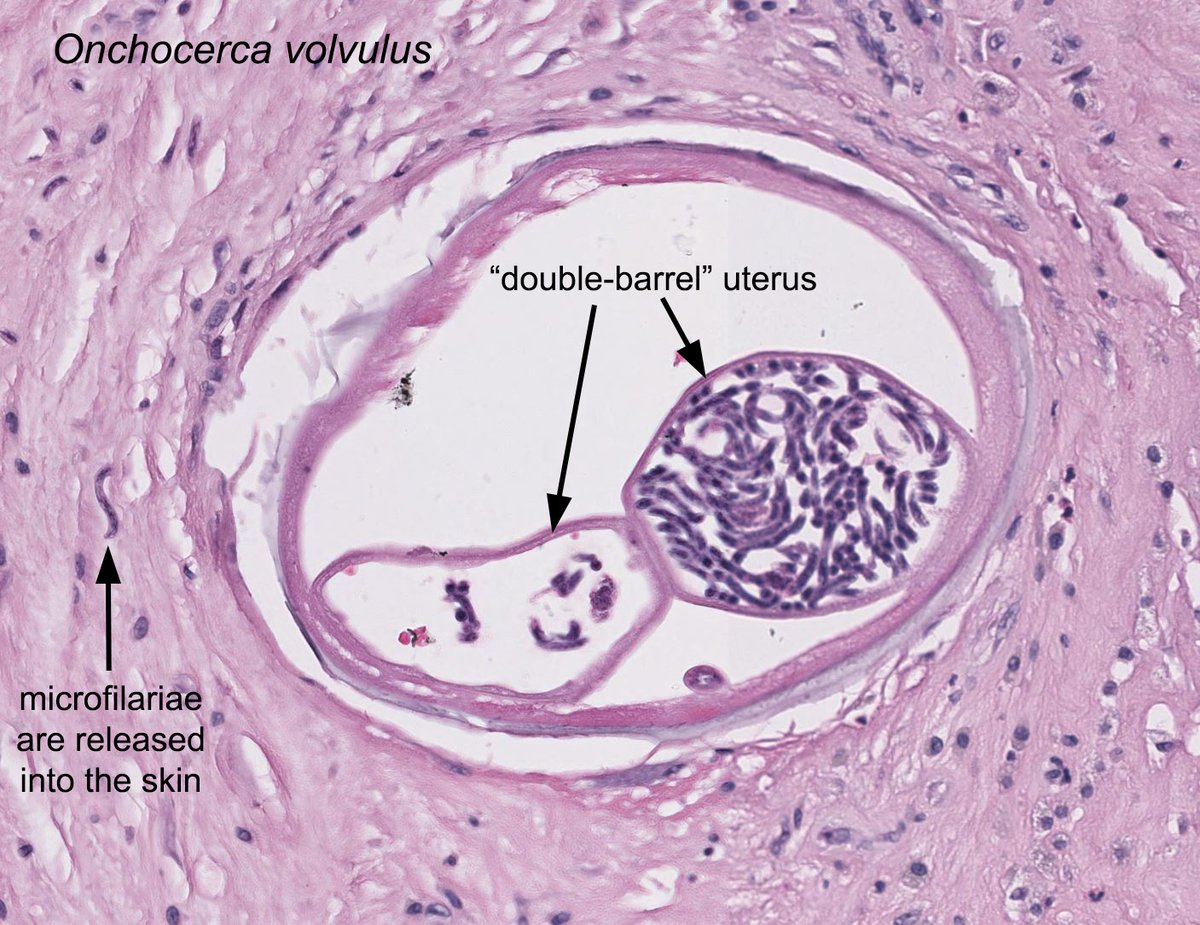Onchocerca Volvulus Microfilariae