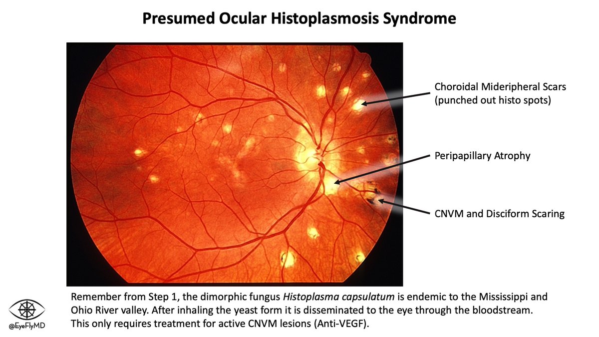 Histoplasmosis Eye