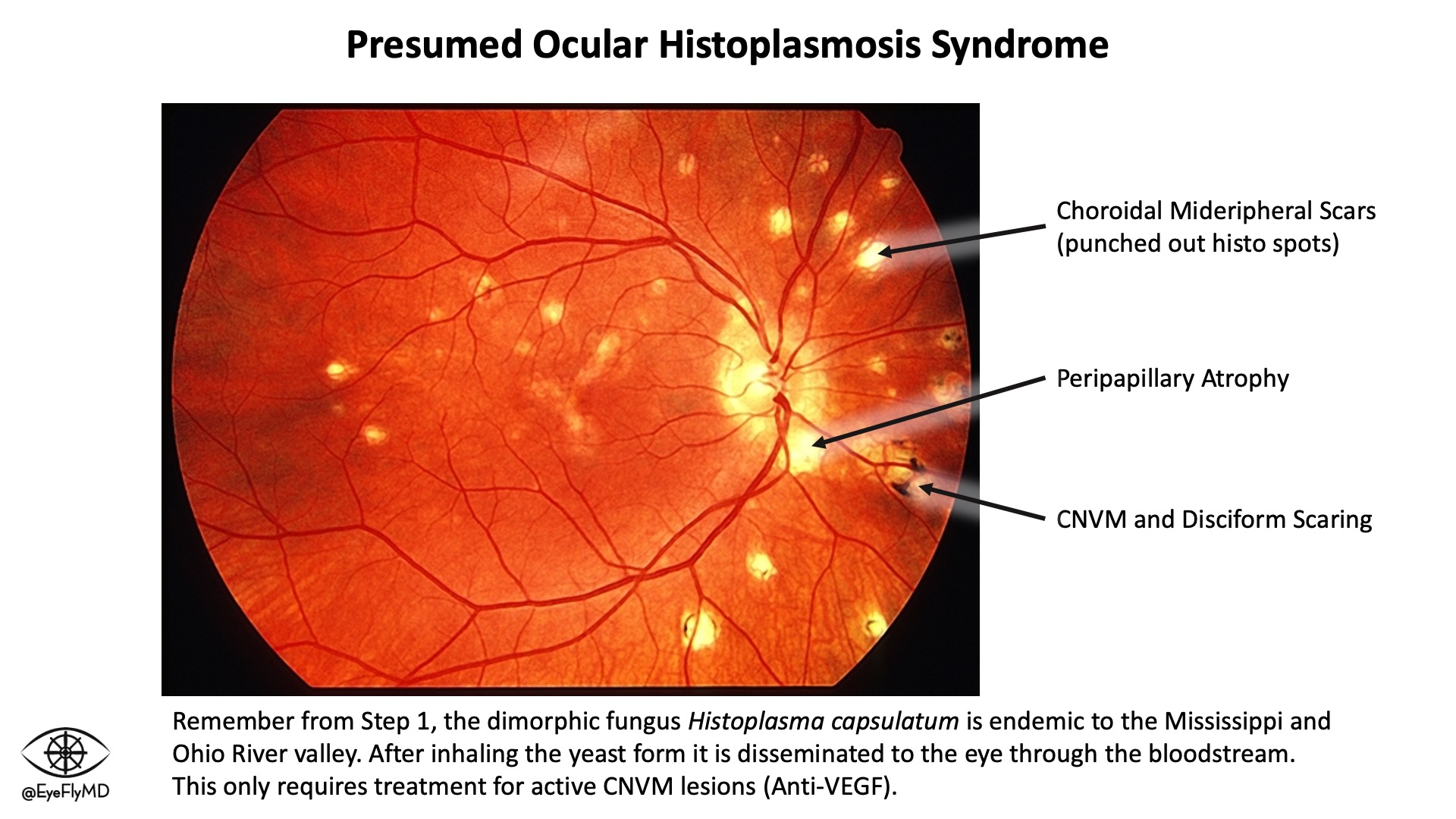 Old Presumed Ocular Histoplasmosis Syndrome Retina Image
