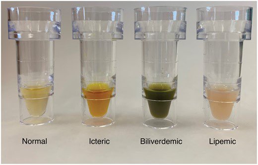 Icteric Specimen