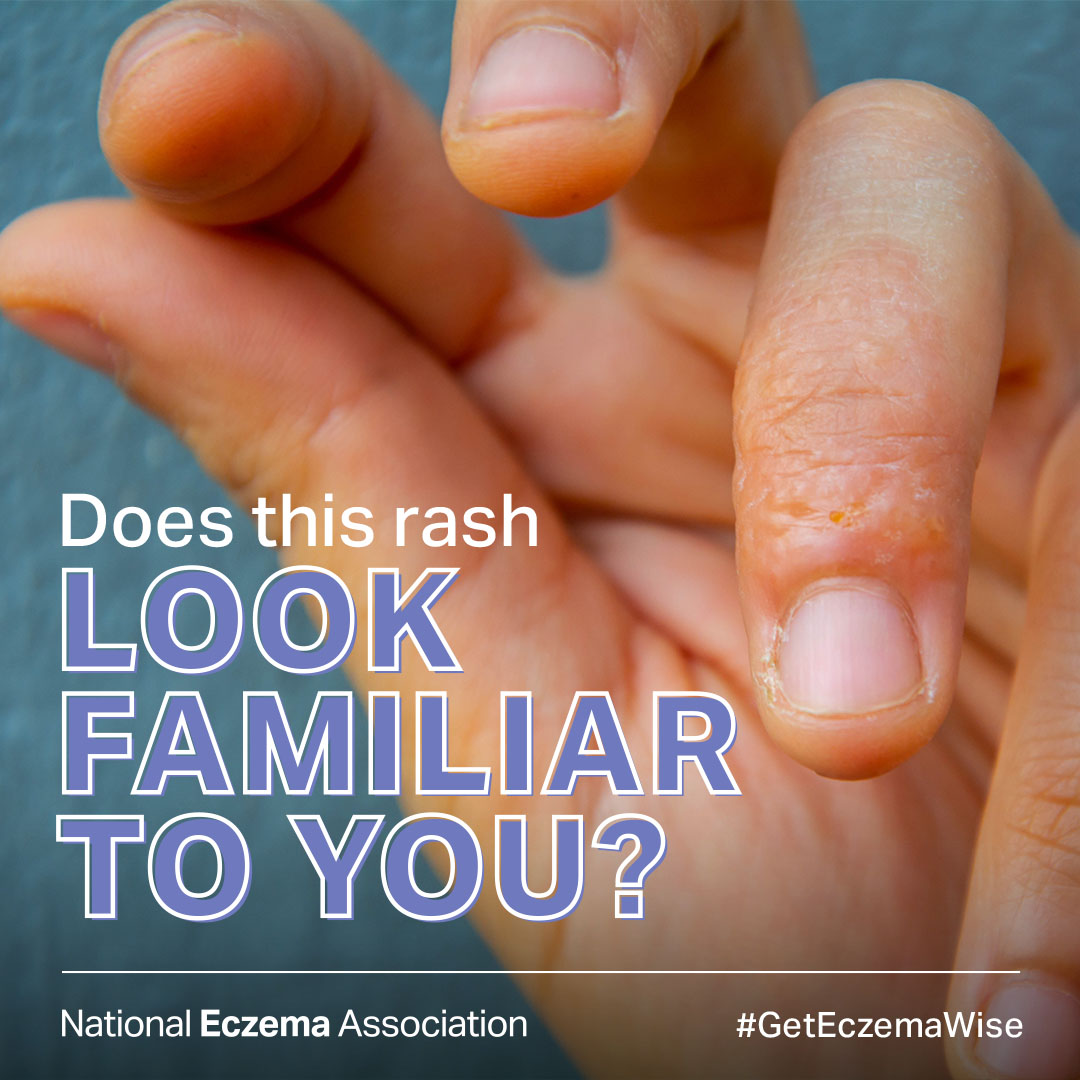 Dyshidrotic Eczema Nail