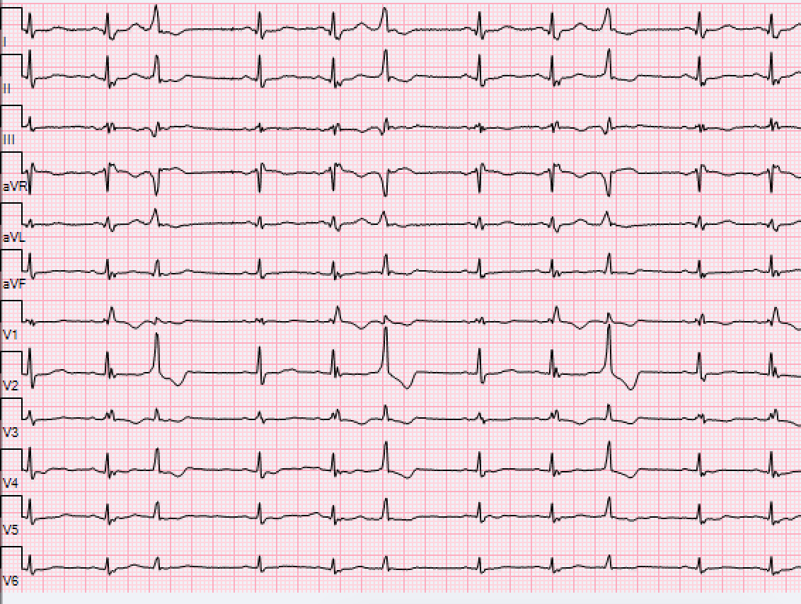Ventricular Trigeminy