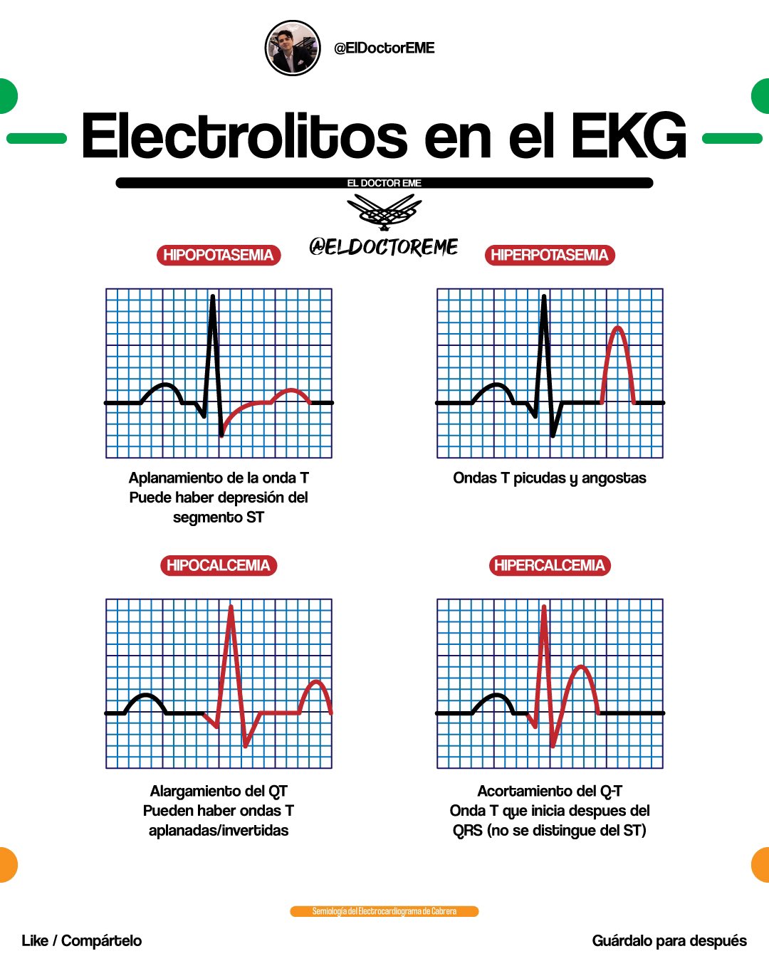 Electrocardiograma De Hipercalcemia