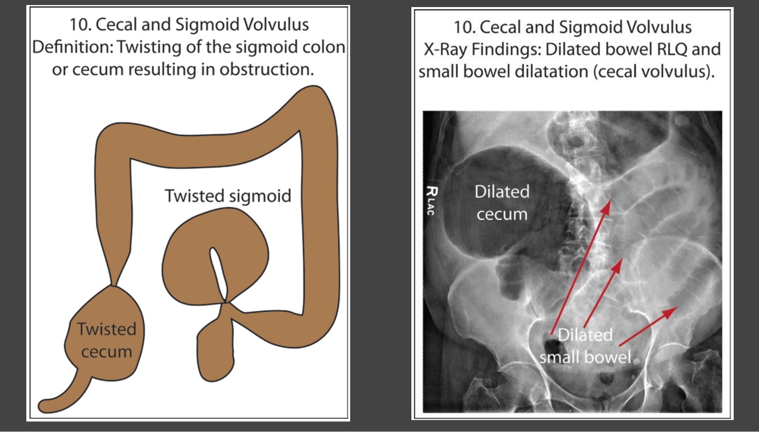 Cecal Volvulus