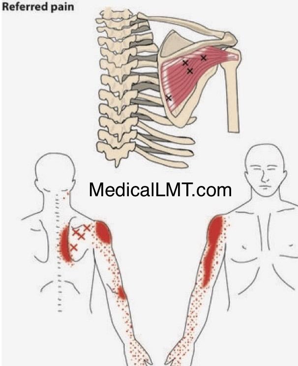 Infraspinatus Pain